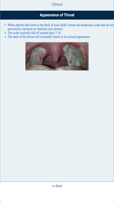 Tonsillectomy Scabs Day 5